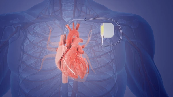 Micra Pacemaker: The World's Smallest Heart Device